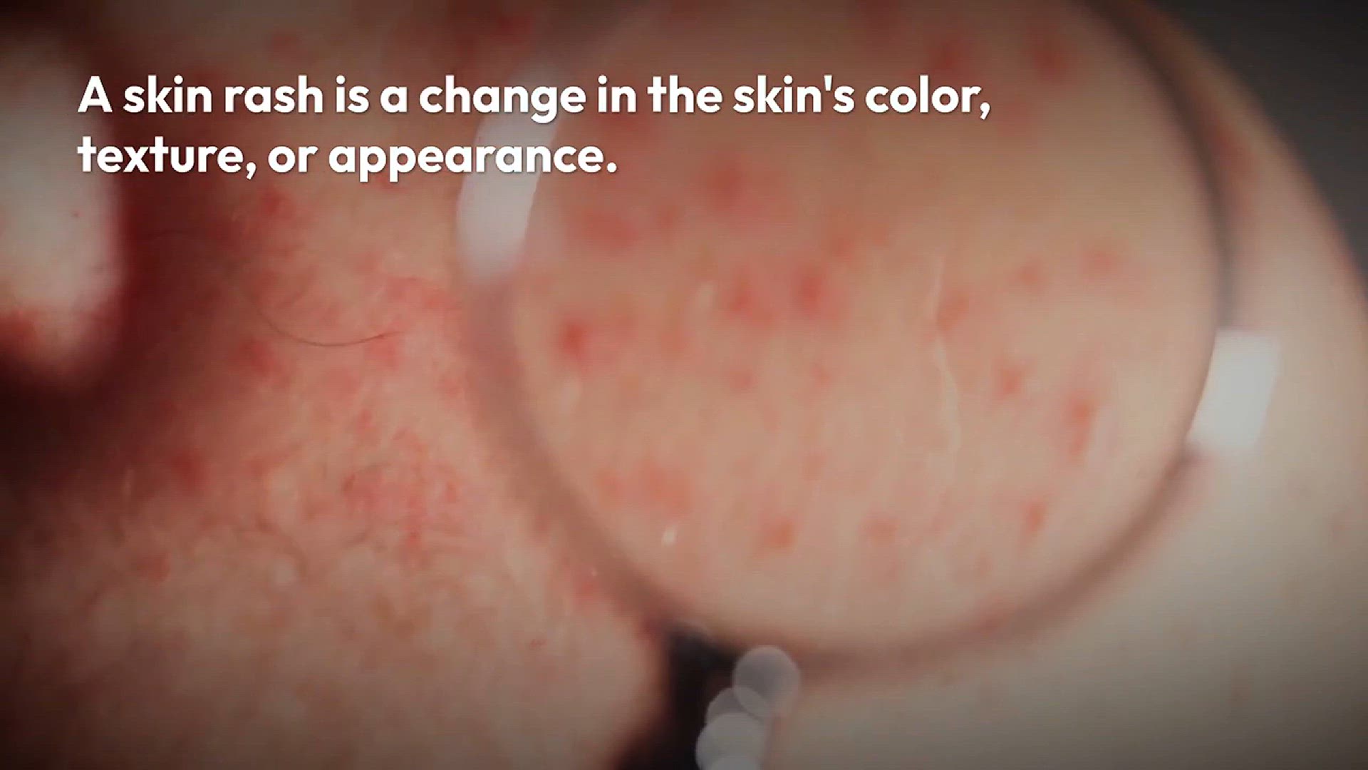 Understanding Skin Rash Triggers | Open Video